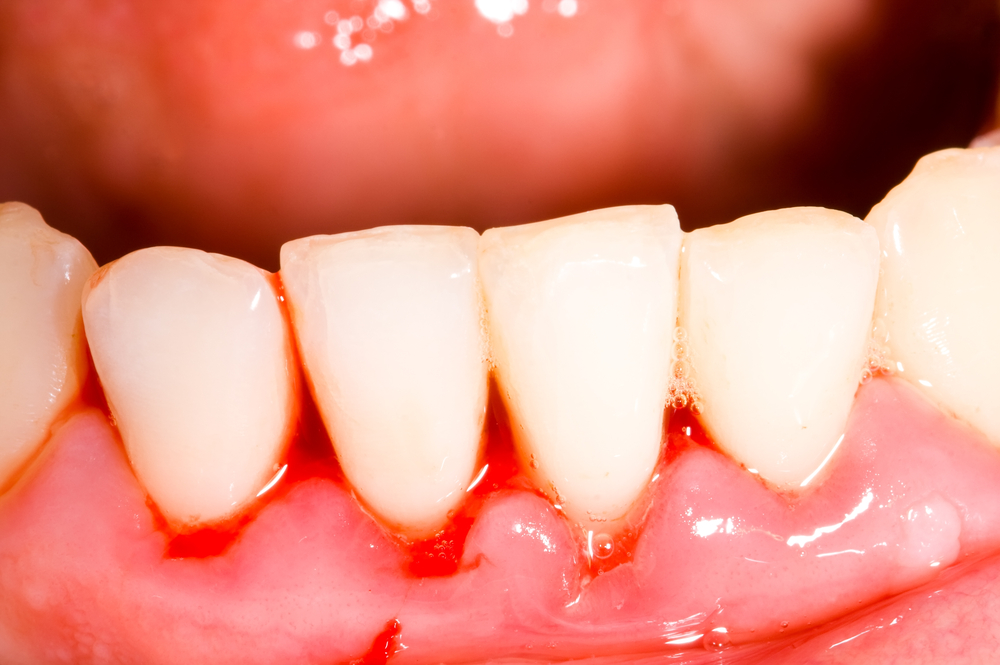 Gingivitis: anti-inflammatory agents may be beneficial