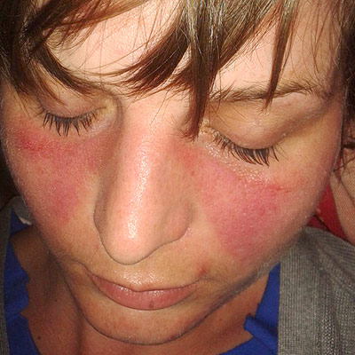 Systemic Lupus Erythematosus: What are the orofacial manifestations and ...